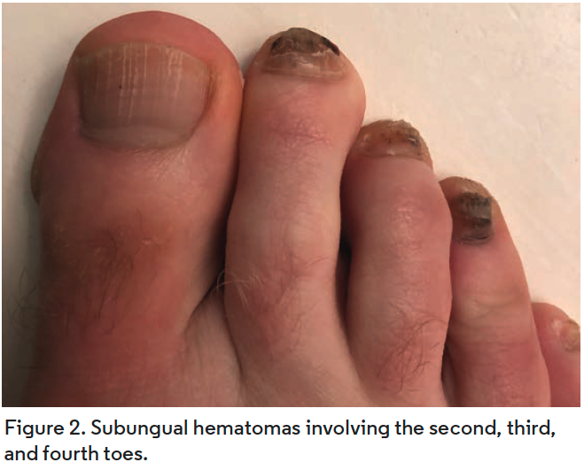 Skin Findings In Runners More Than Just Black And Blue Toes